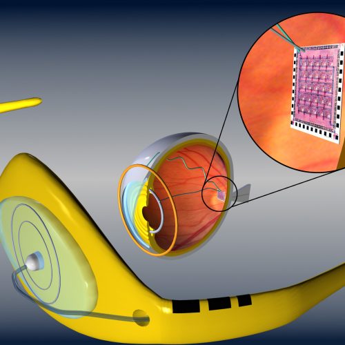 Tag: retinal implants - Ars Technica