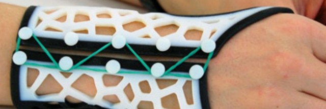 3D-printed splints may make life better for arthritis sufferers | Ars ...