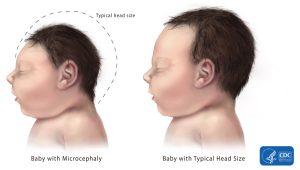 CDC confirms Zika causes microcephaly; birth defect may be “tip of the ...