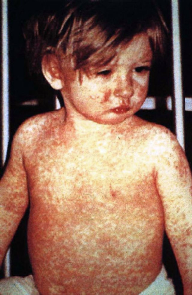 Study: US is slipping toward measles being endemic once again - Ars ...