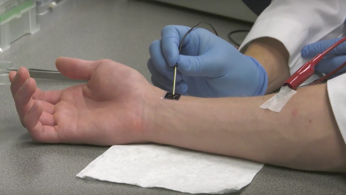 Heal thyself: Skin-zapping chip aims to reprogram cells for tissue ...