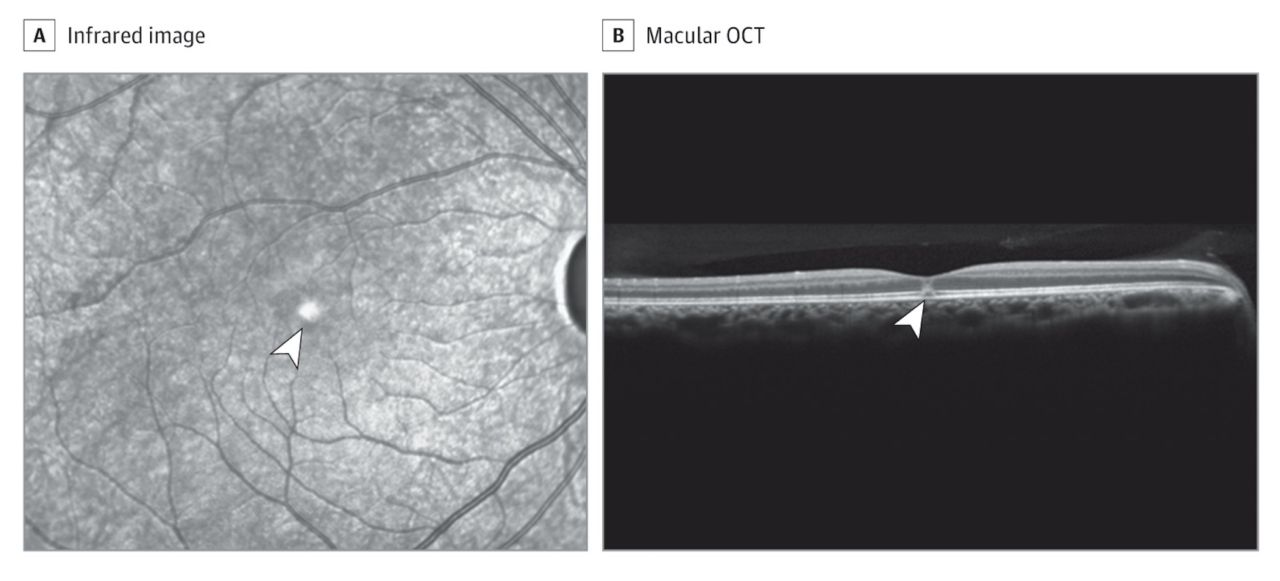 Here’s what happens to your retina if you view an eclipse without ...