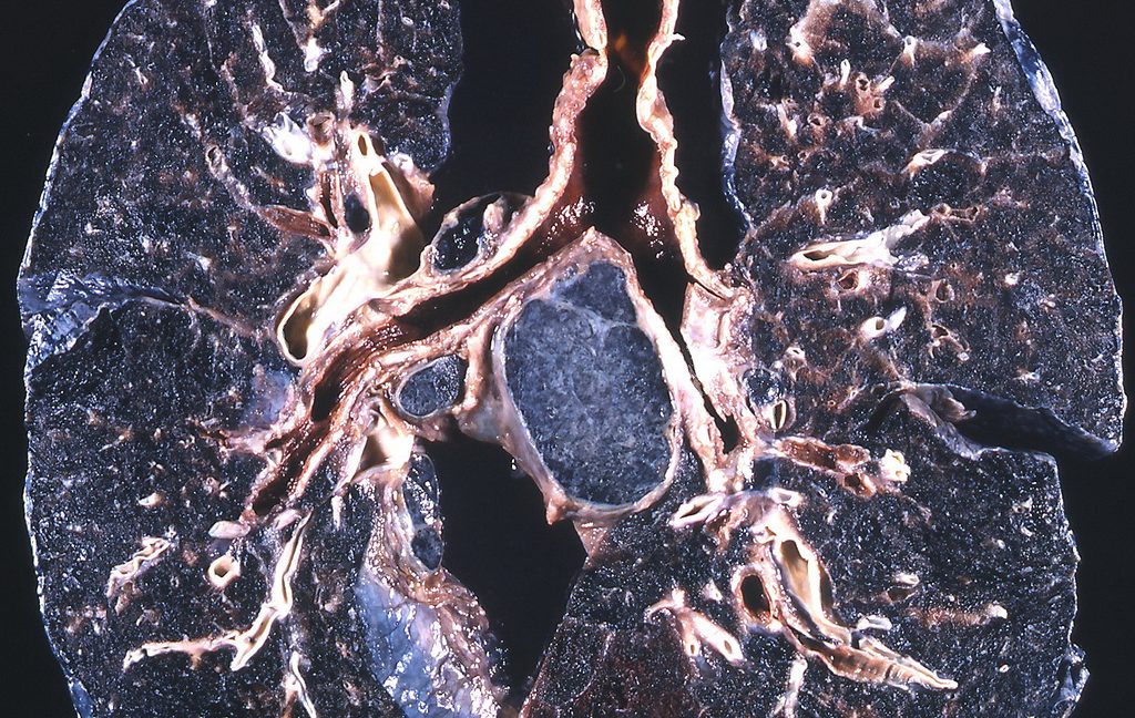 Doctors floored by epidemic levels of black lung in Appalachian coal ...
