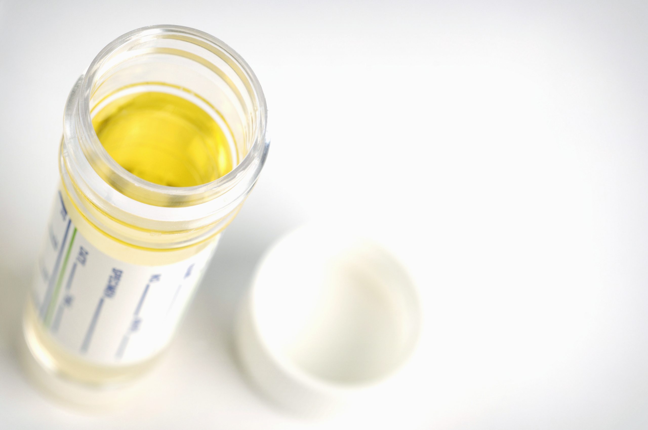 Just pee in a cup for bladder cancer detection - Ars Technica