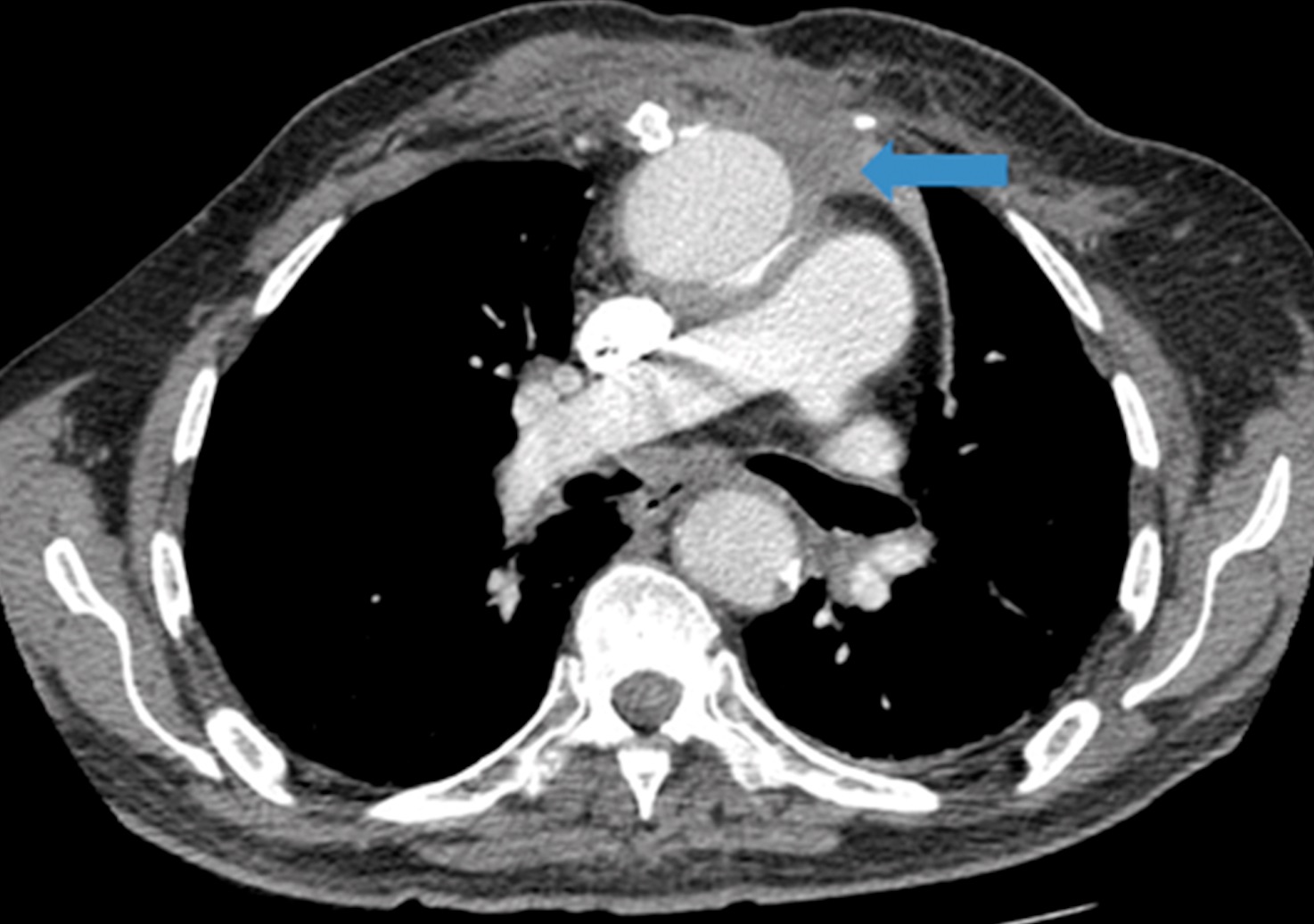 Virus fished from pond cures man’s deadly antibiotic-resistant ...