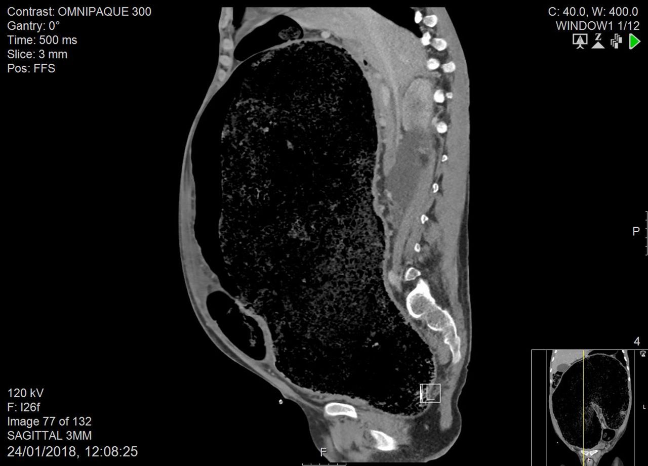 Explosive case of poop-packed “megacolon” prompts warning from doctors ...
