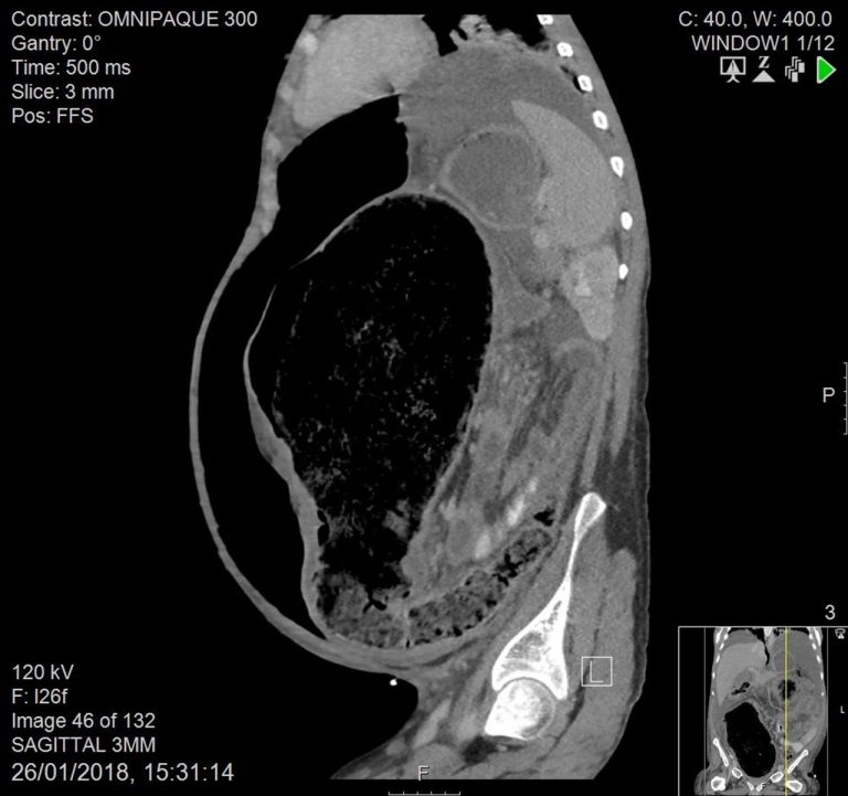 Explosive case of poop-packed “megacolon” prompts warning from doctors ...