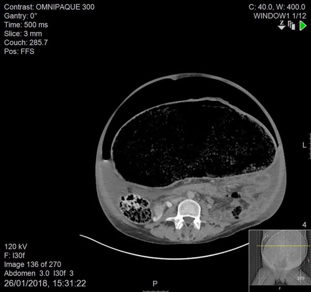 Explosive case of poop-packed “megacolon” prompts warning from doctors ...