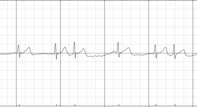 A look at the Apple Watch’s ECG, from someone who needs it - Ars Technica