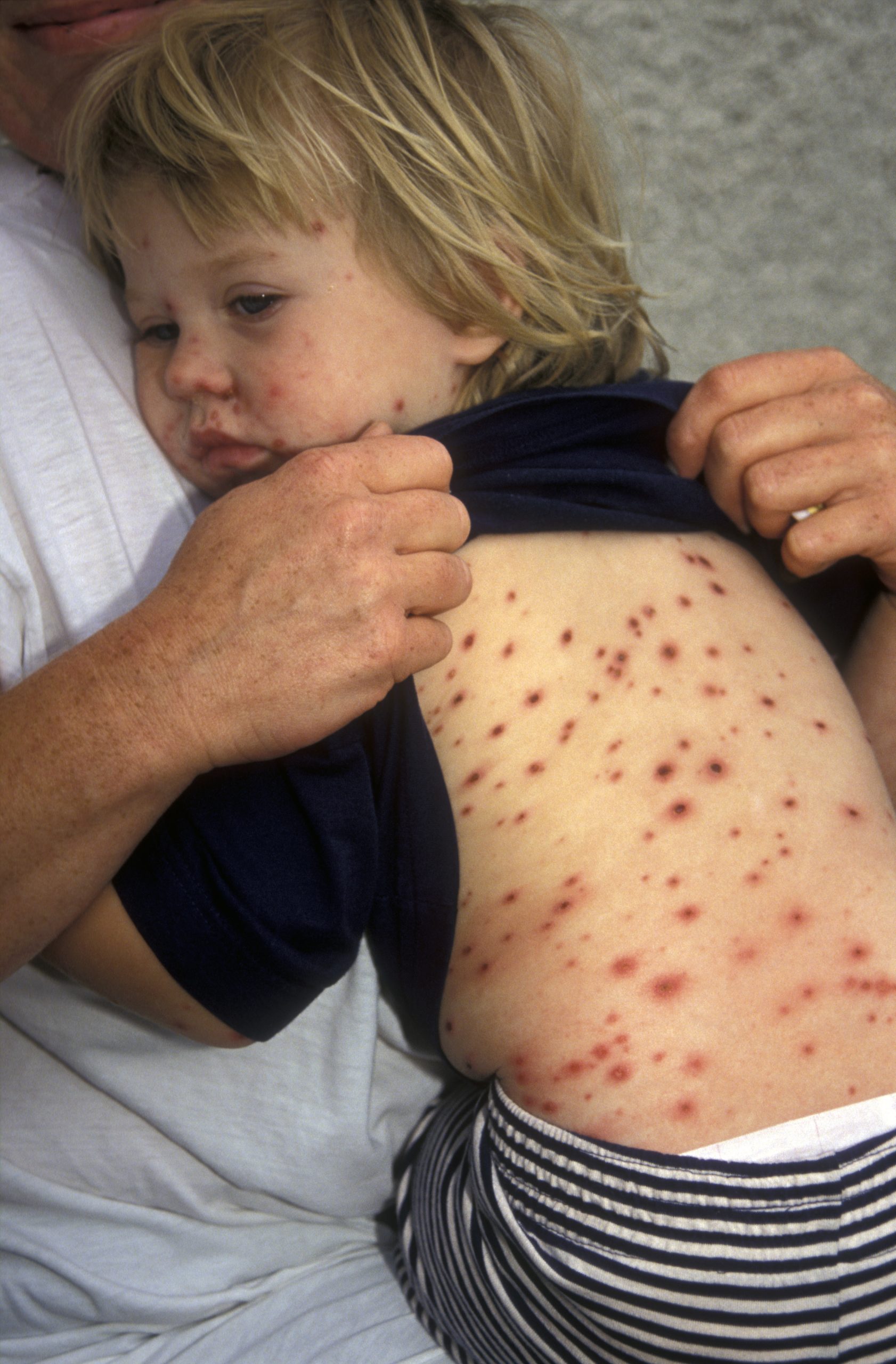 Anti-vax teen that fought ban amid chickenpox outbreak loses in court ...
