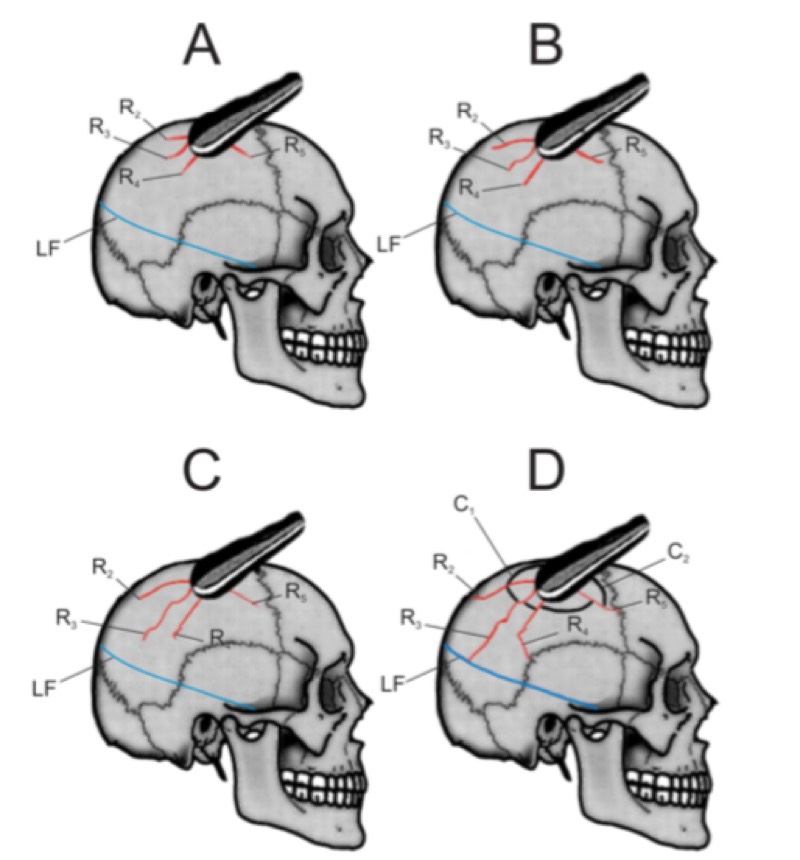Study concludes 33,000-year-old skull shows signs of blunt-force trauma ...