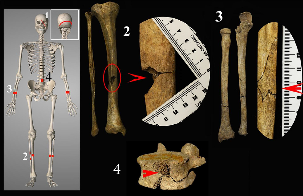 Medieval skeleton puts a face on accounts of torture and violence - Ars ...