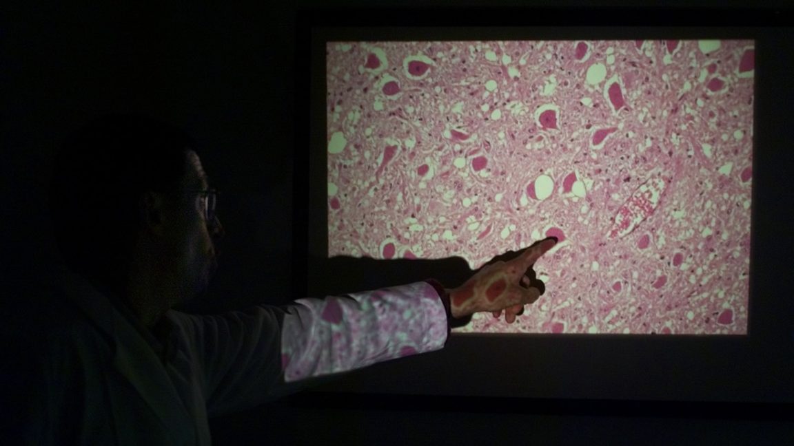 Second lab worker with deadly prion disease prompts research pause in ...