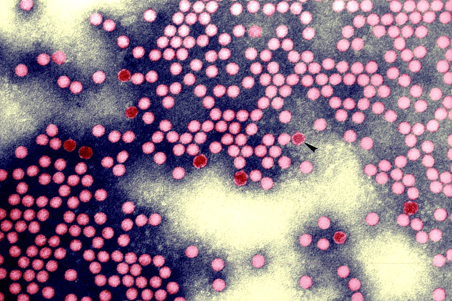 Freak infection with an eradicated form of polio shows virus ...