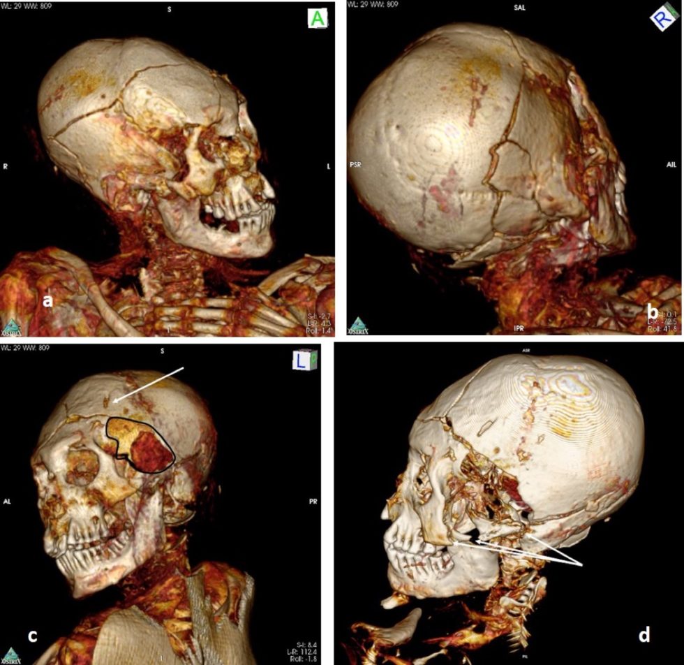 The case of the murdered mummies: “Virtual autopsy” reveals foul play ...