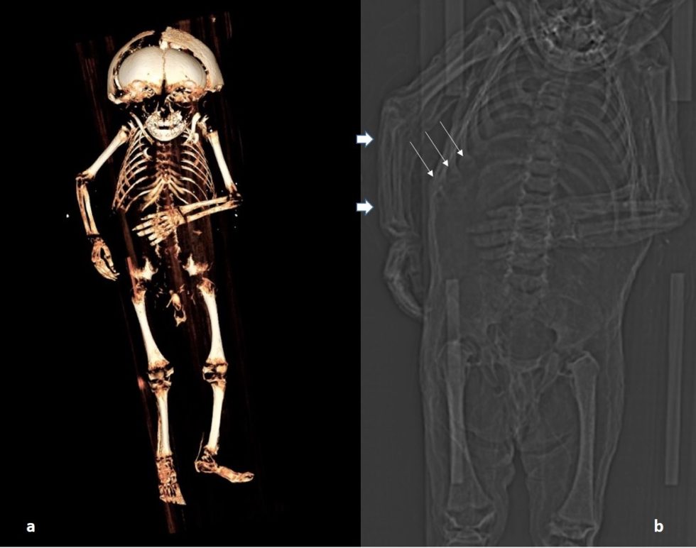 Tale from the crypt: Researchers conduct “virtual autopsy” of mummified ...