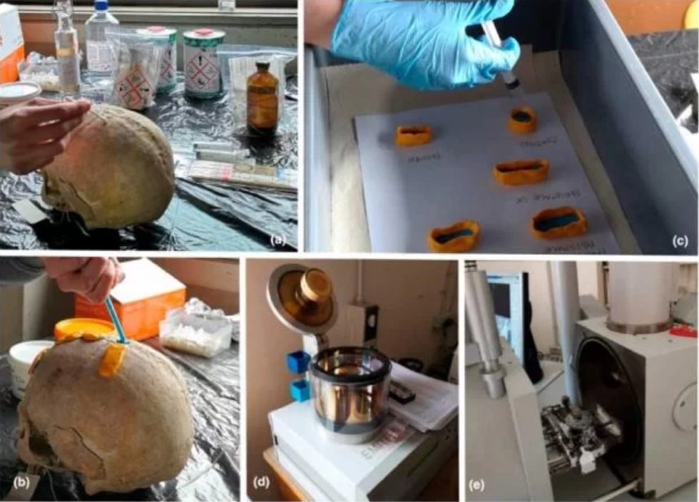 Archaeologists found evidence of trepanation on medieval woman’s skull ...