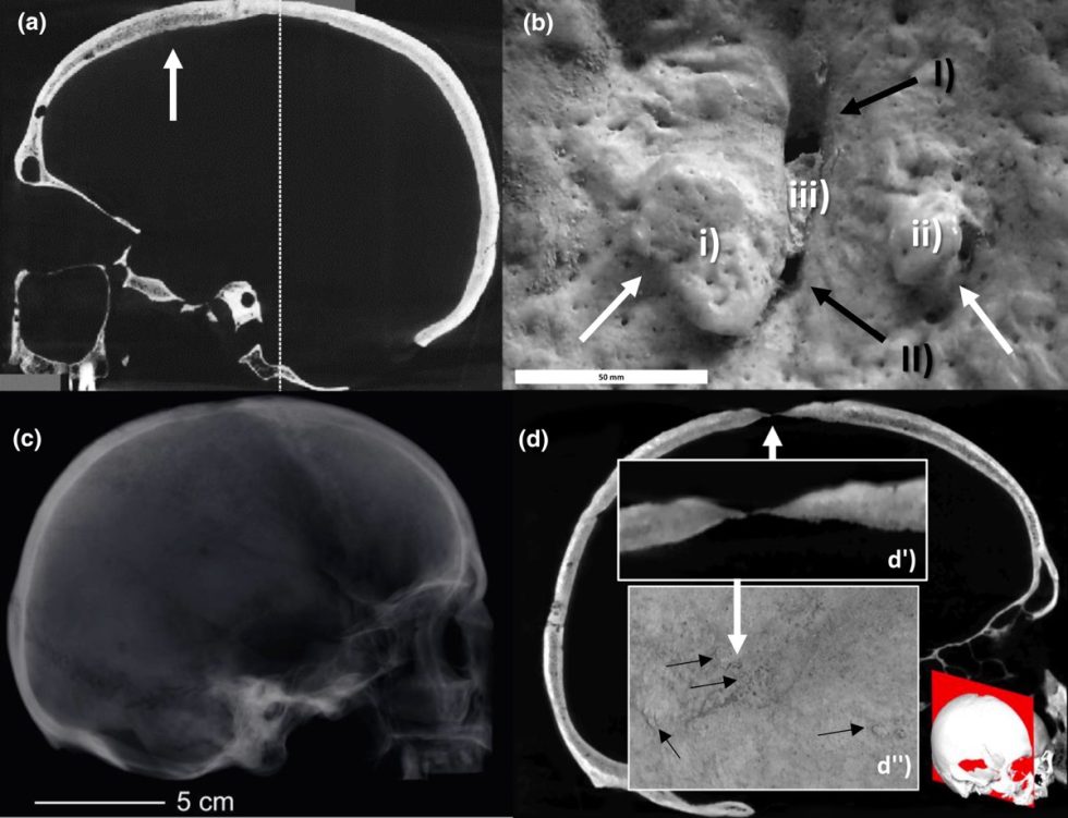 Archaeologists found evidence of trepanation on medieval woman’s skull ...