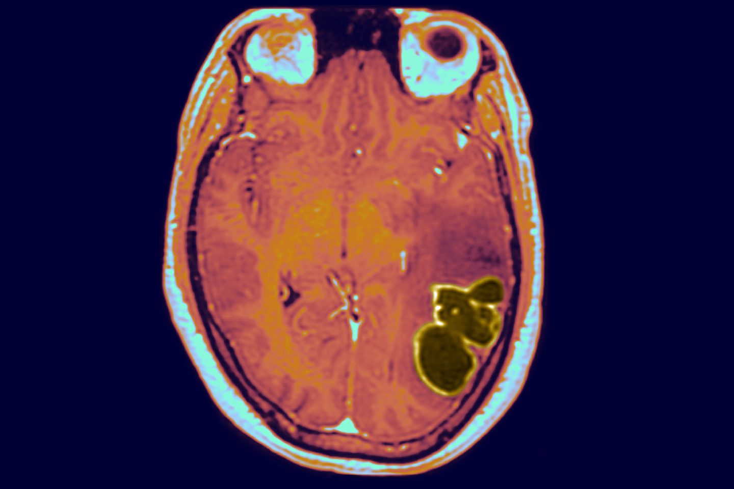 Dangerous brain abscesses spiked in US kids as COVID restrictions ...