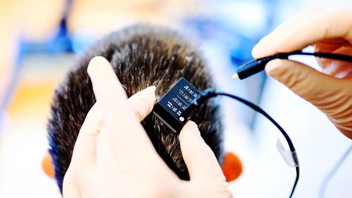 AI-powered brain implants help paralyzed patients communicate faster than ever - Ars Technica