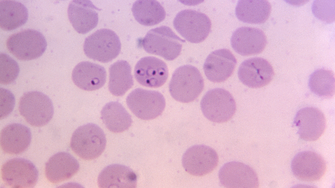 In the US, malaria can easily masquerade as an endemic parasite - Ars ...