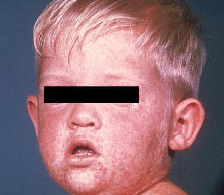 Measles erupts in Florida school where 11% of kids are unvaccinated ...