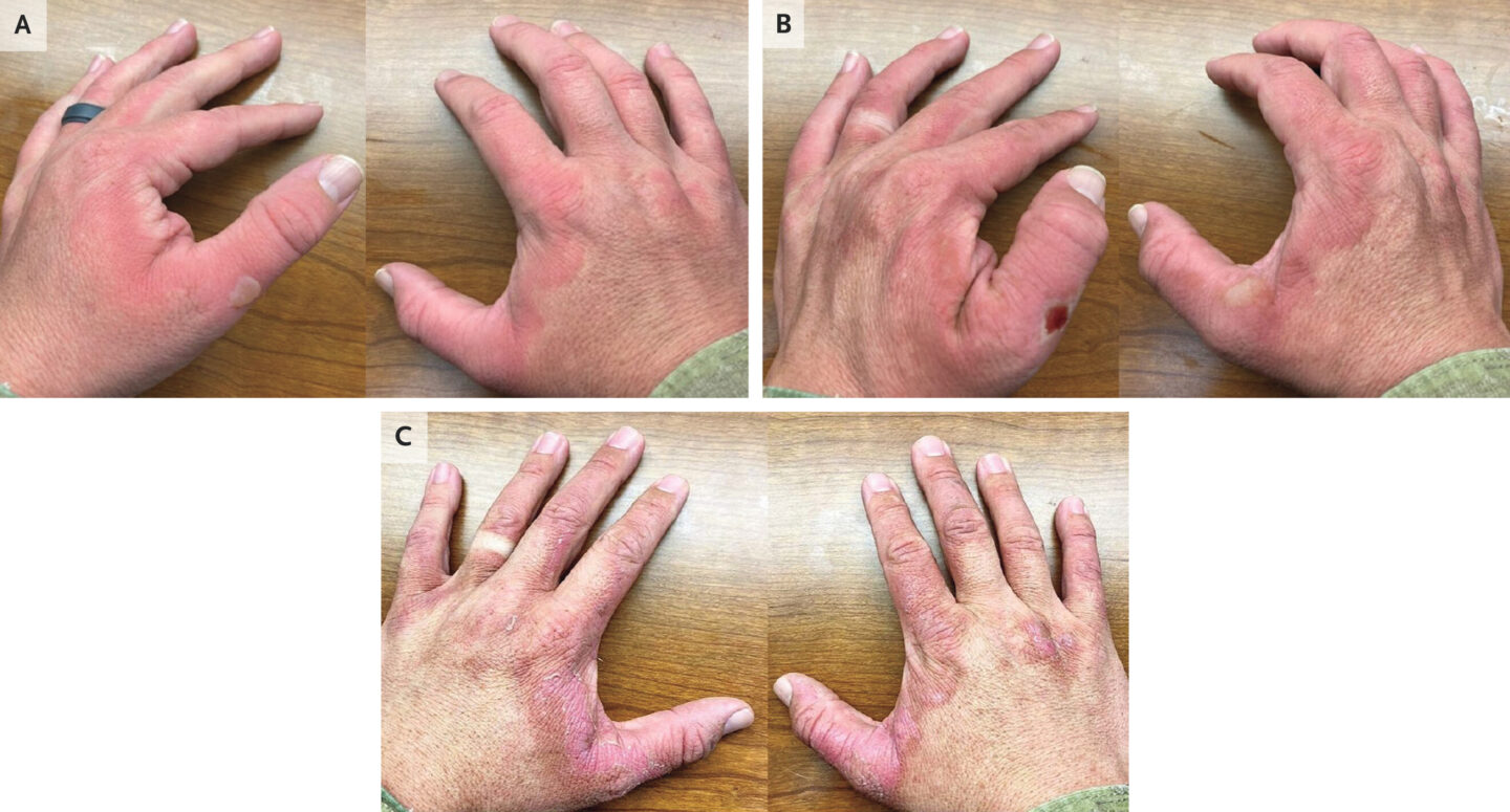 Man suffers chemical burn that lasted months after squeezing limes ...