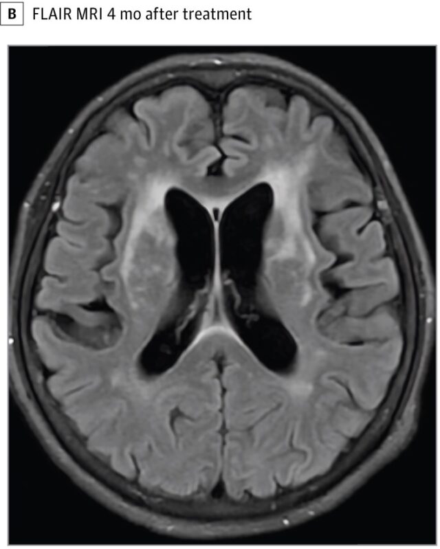 This is what it looks like when parasitic worms directly invade your ...