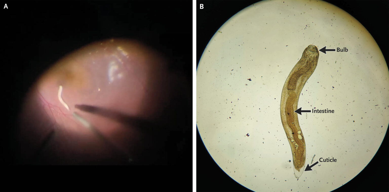 Worm invades man’s eyeball, leading doctors to suck out his eye jelly ...