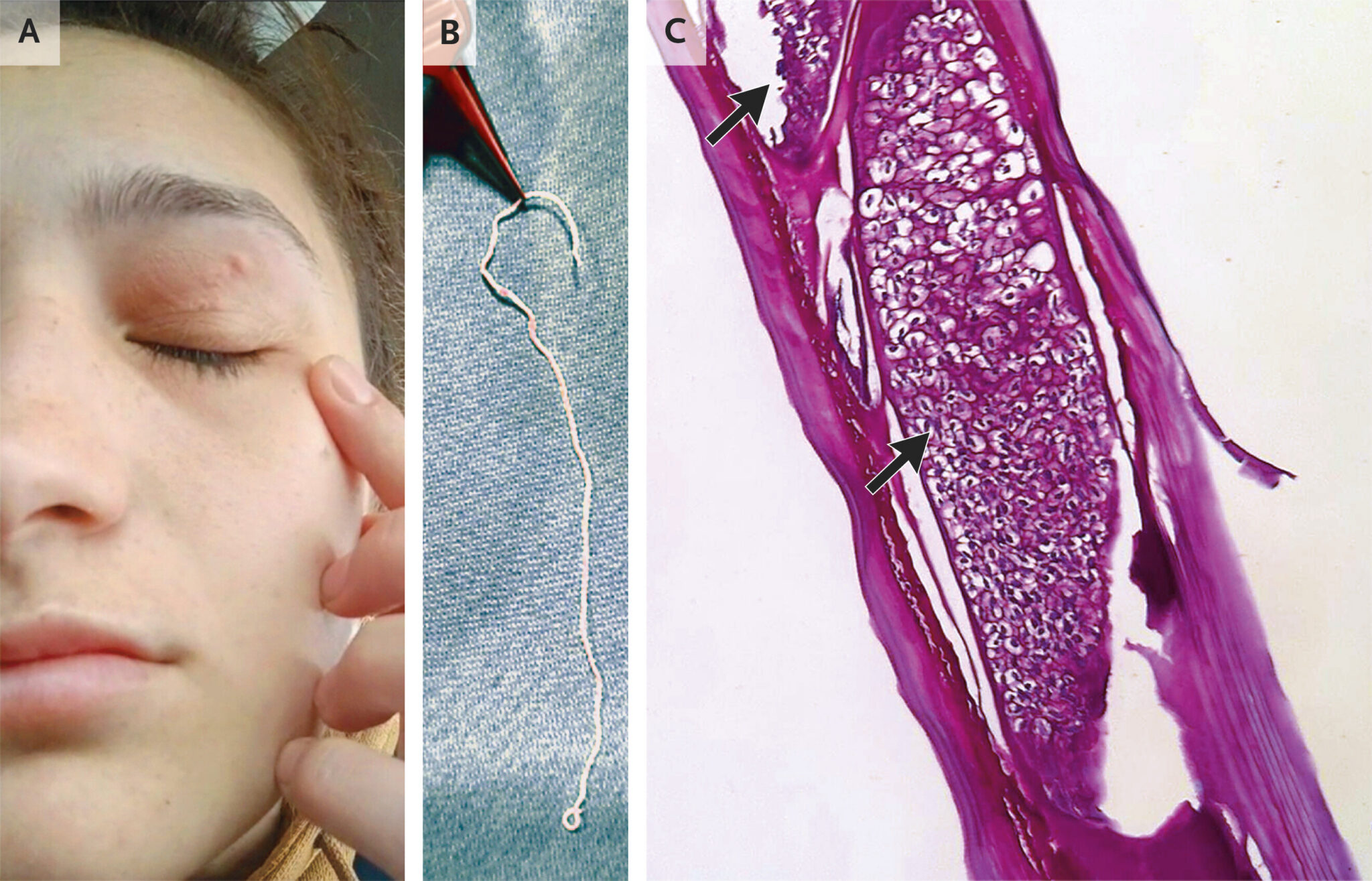 Four-inch worm hatches in woman’s forehead, wriggles to her eyelid ...
