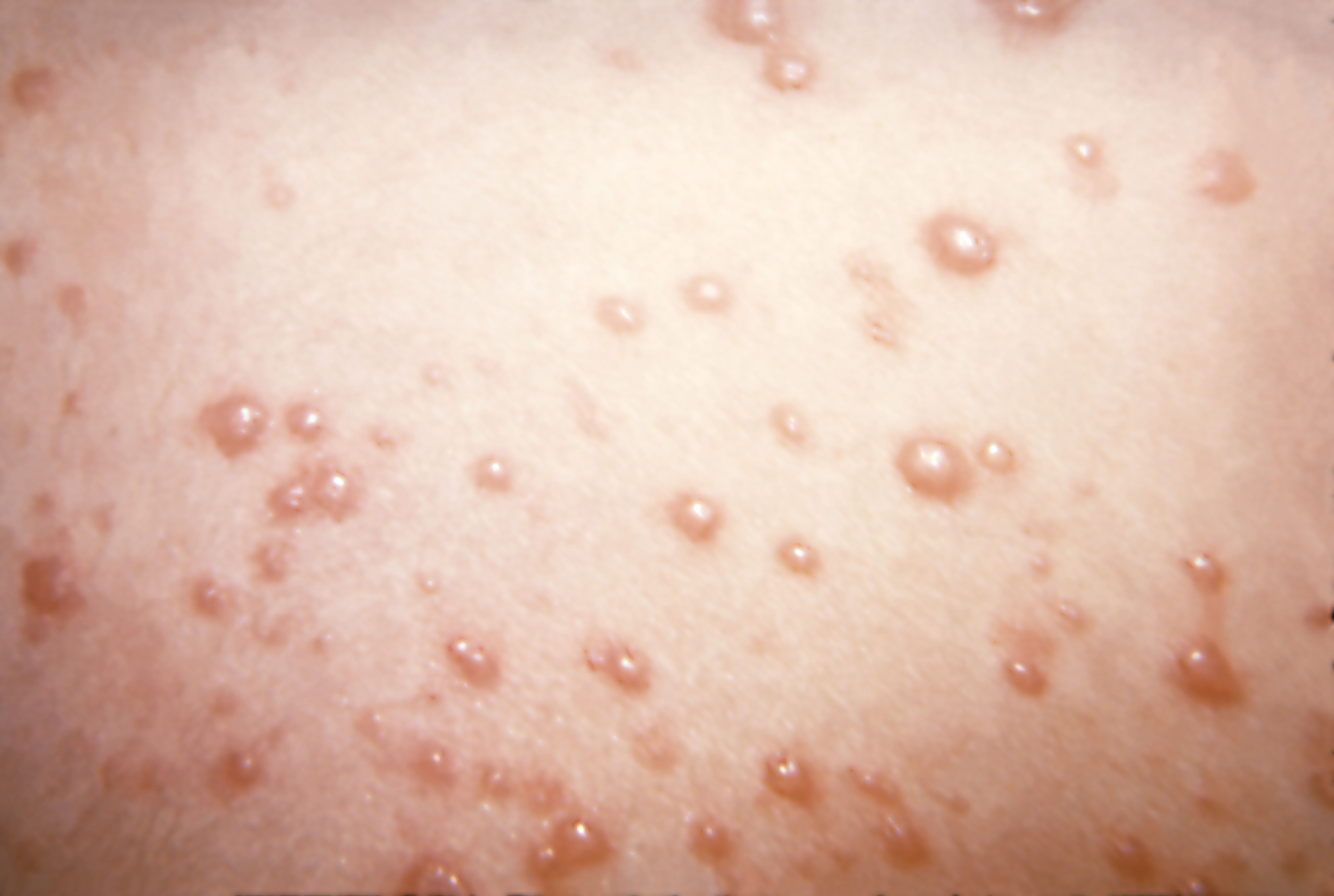In rare chickenpox case, itchy blisters mushroom into large, rubbery ...