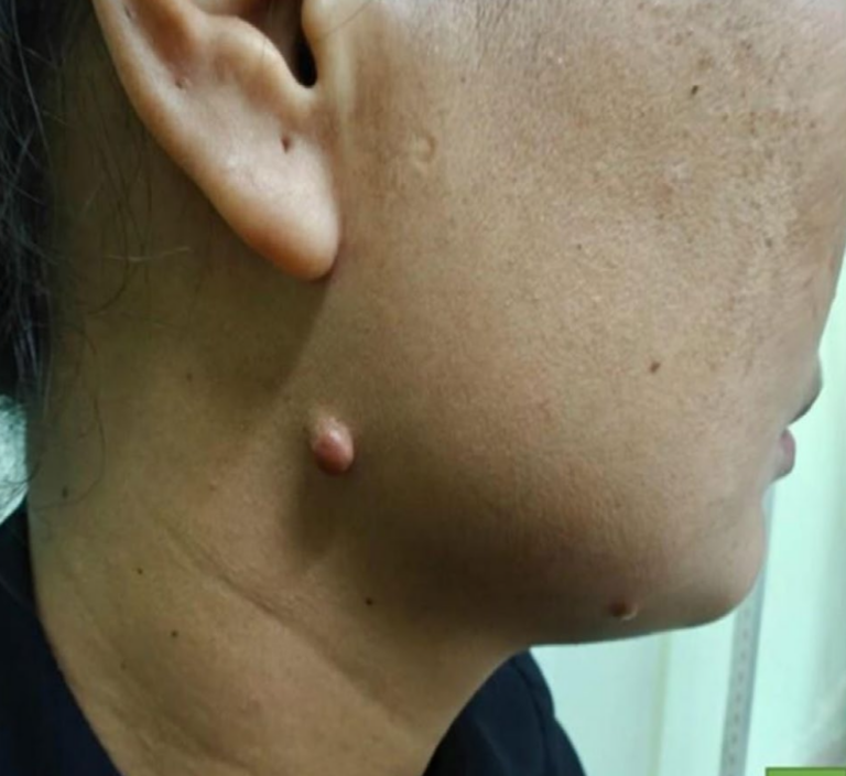 In rare chickenpox case, itchy blisters mushroom into large, rubbery ...